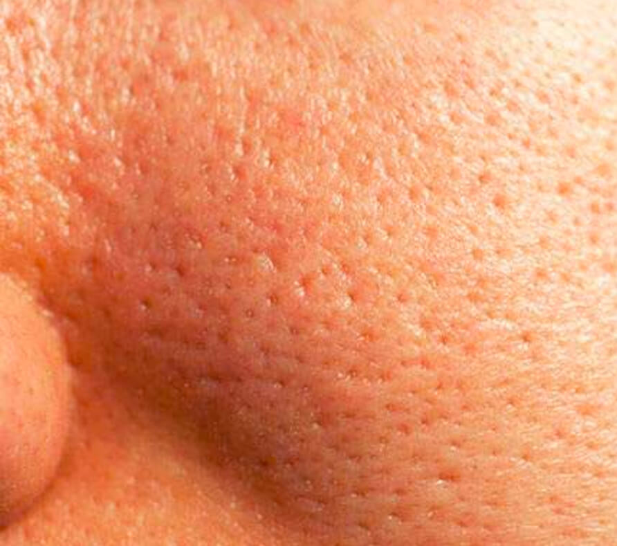 Enlarged Pores Treatments | Avenue Advanced Skin Care