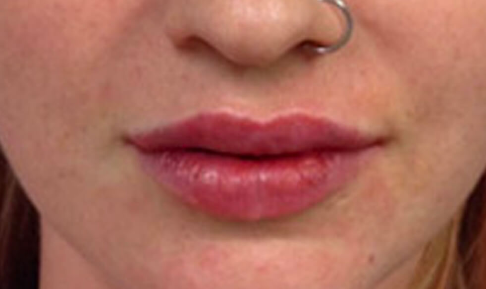 Lip Augmentation Melbourne - Fat Transfer to Lips | AASC