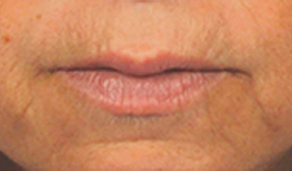 Fotona Laser for Fractional Skin Resurfacing | AASC