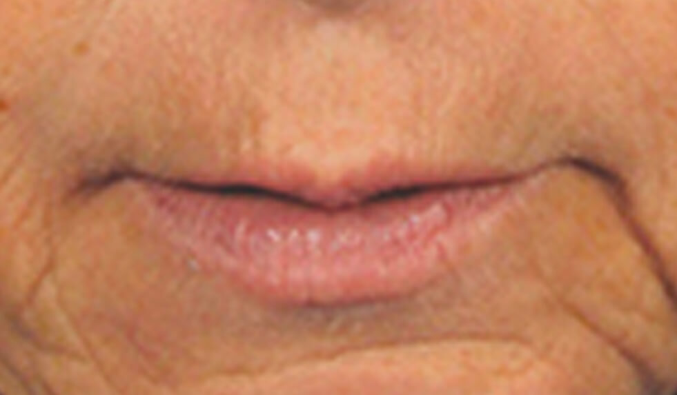 Fotona Laser for Fractional Skin Resurfacing | AASC