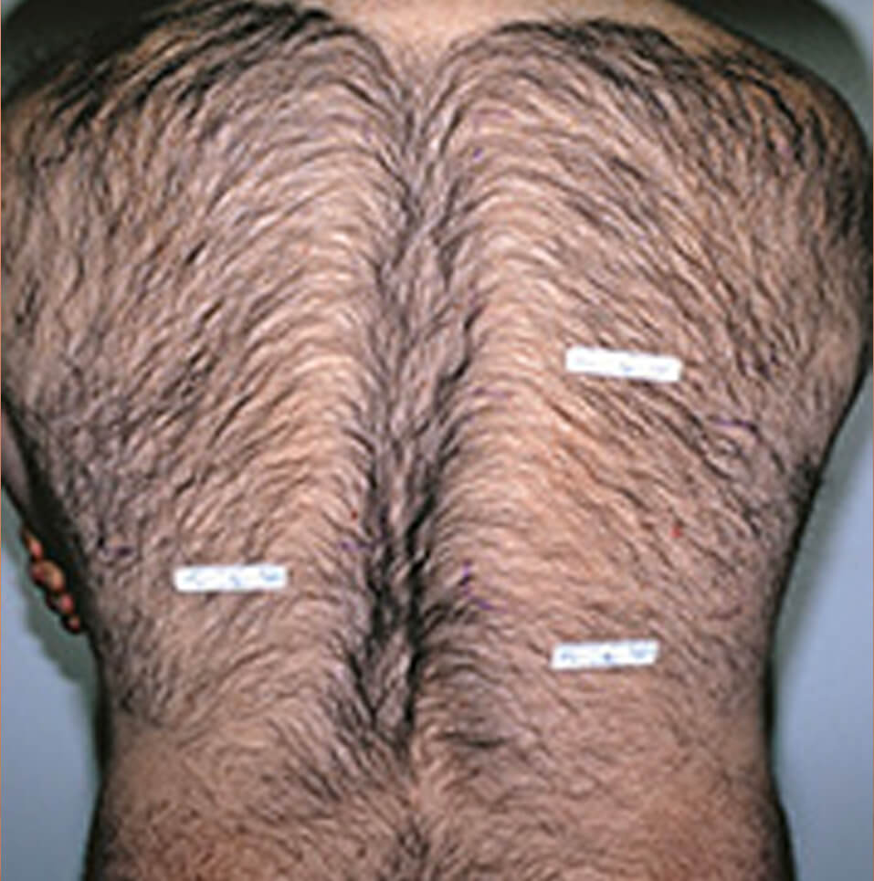 Fotona Laser/Palomar Starlux IPL Hair Removal | AASC