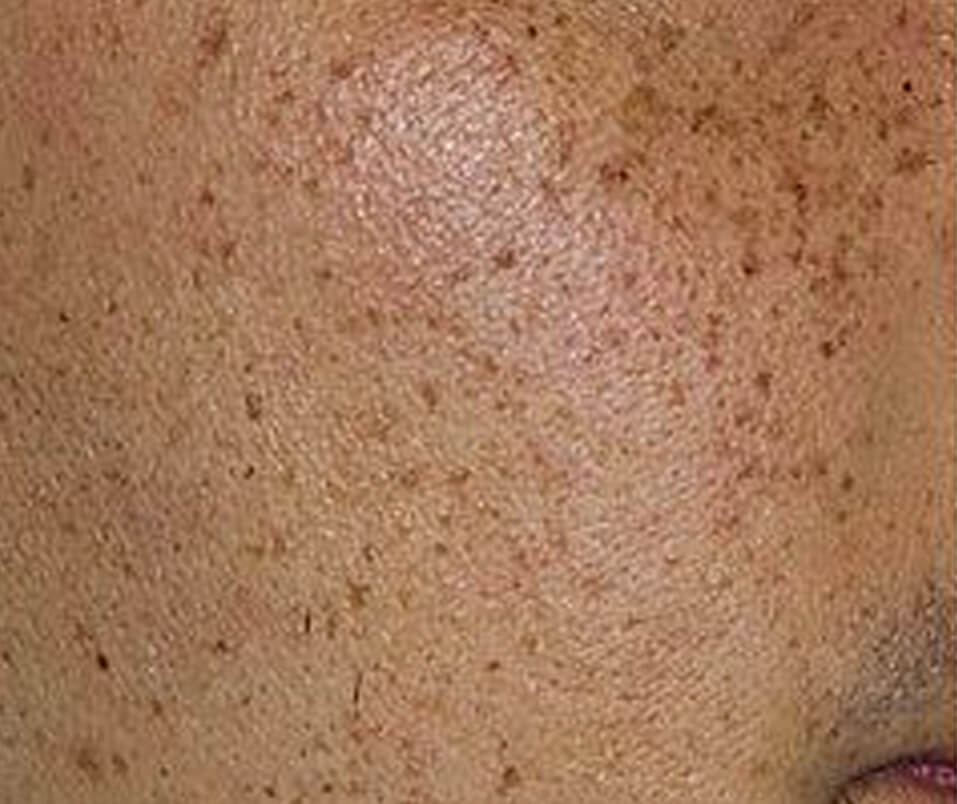 Fotona Laser for Pigmentation Treatment Melbourne | AASC