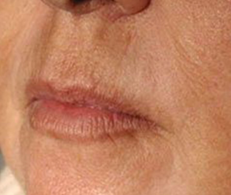 Fotona Laser for Fractional Skin Resurfacing | AASC