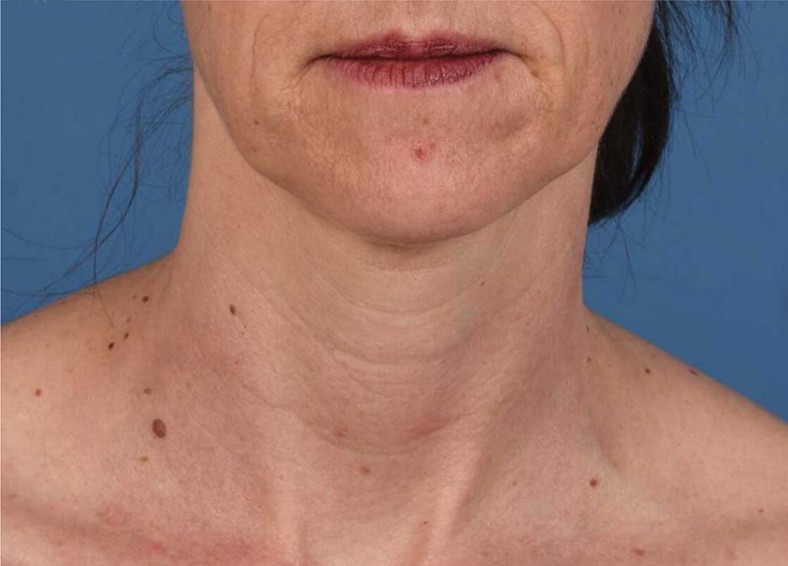 DermaPen Skin Needling Treatment Melbourne | Avenue Advanced Skin Care